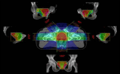Intensitätsmodulierte Strahlentherapie in Bad Homburg